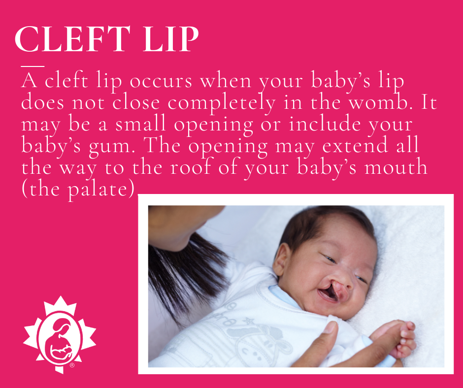 Breastfeeding Help Cleft Lip at Martin Clark blog